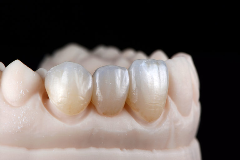 High Translucent Zirconia – Studio32 Dental Laboratory