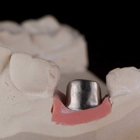 Custom Abutments – Studio32 Dental Laboratory